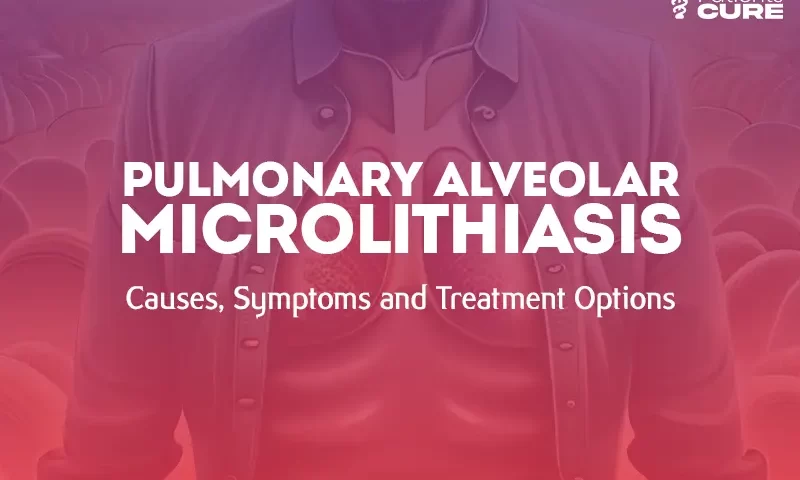 Pulmonary Alveolar Microlithiasis: Symptoms, Causes, Treatment